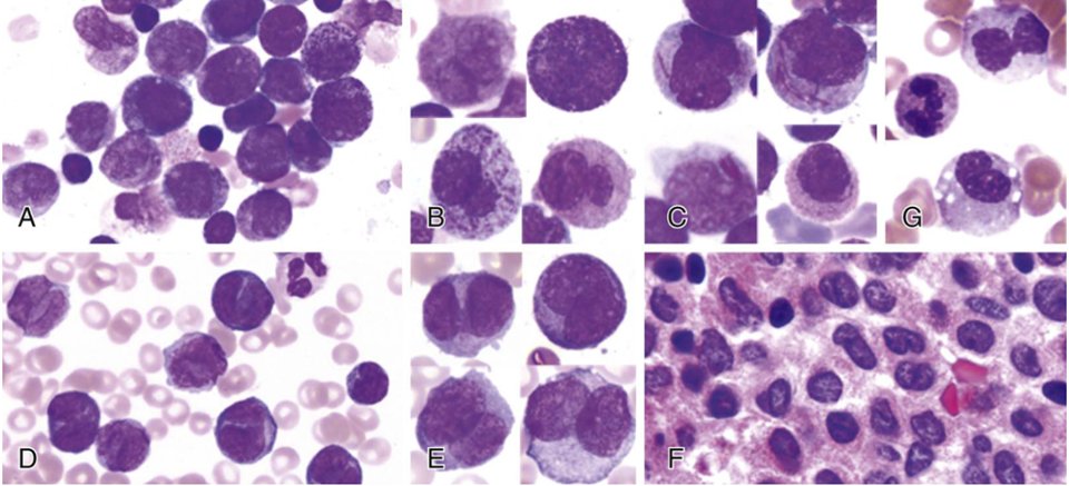 Acute Promyelocytic Leukemia Microgranular Variant