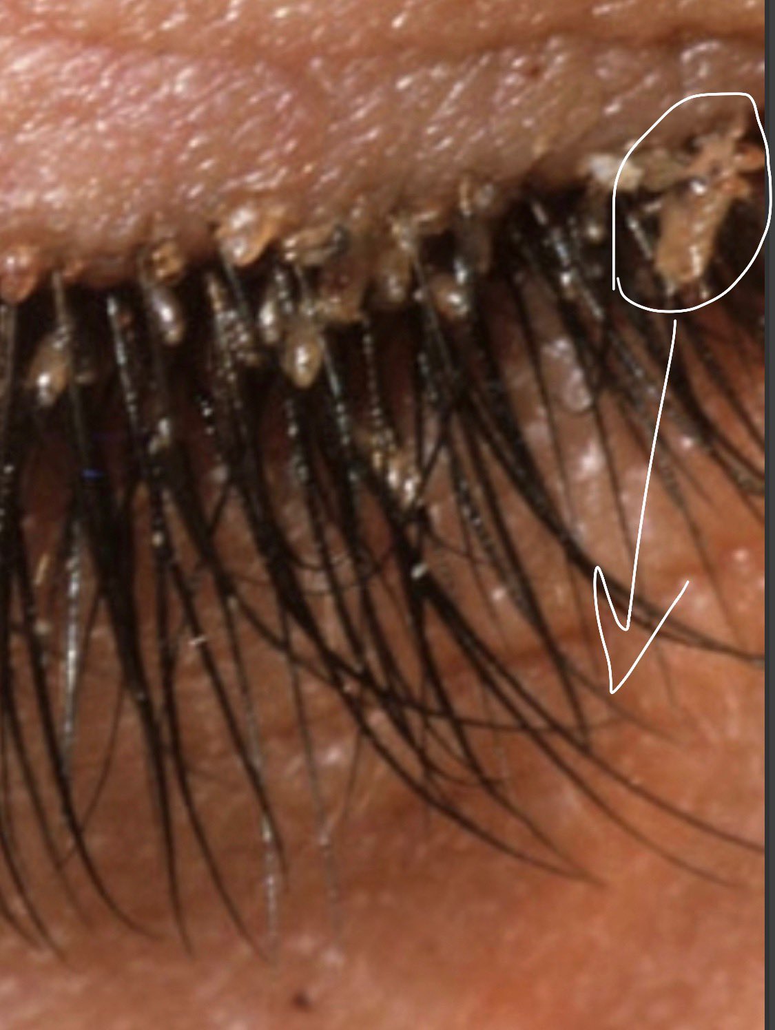 Pediculosis Eyelashes