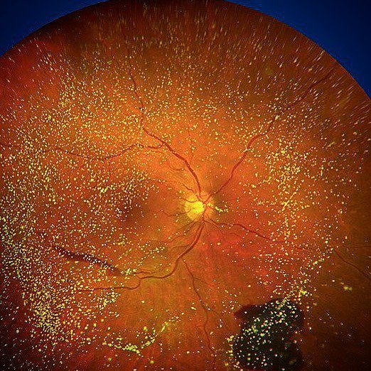 Asteroid Hyalosis Retina