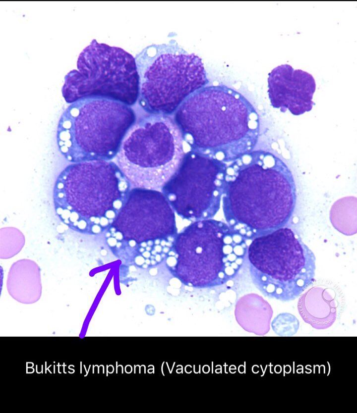 L1 Lymphoblast