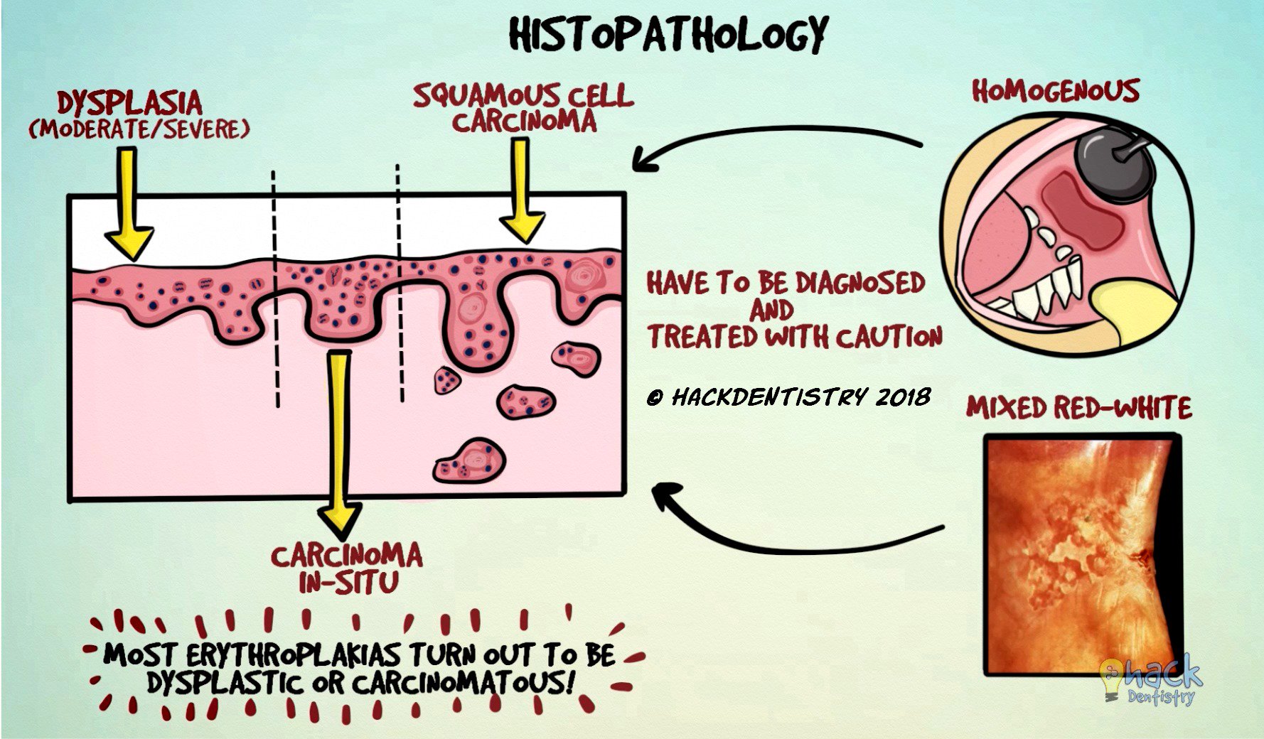 Erythroplakia Histopathology Label Based Comparative Proteomics Of