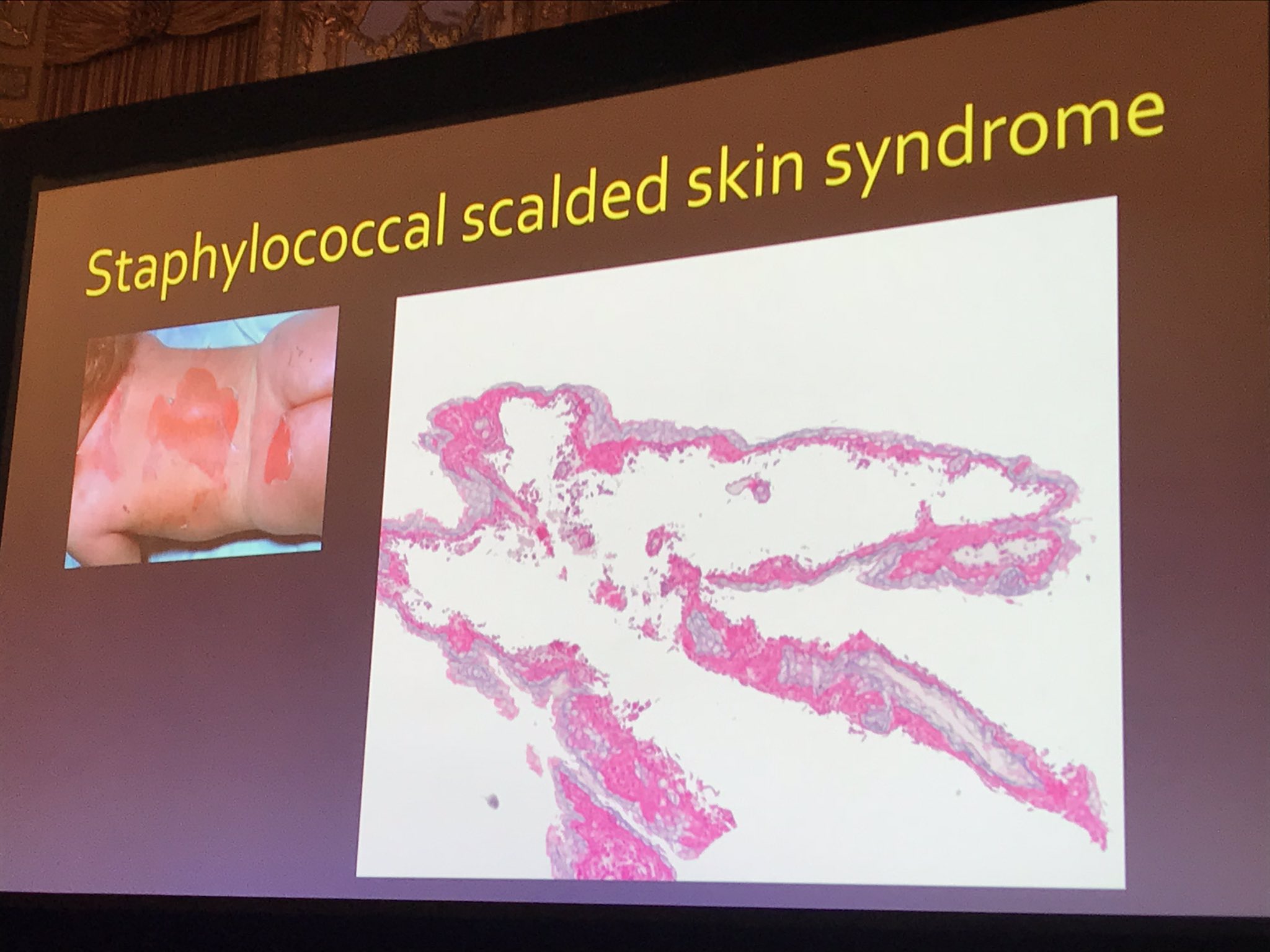 Staphylococcal Scalded Skin Syndrome Histology