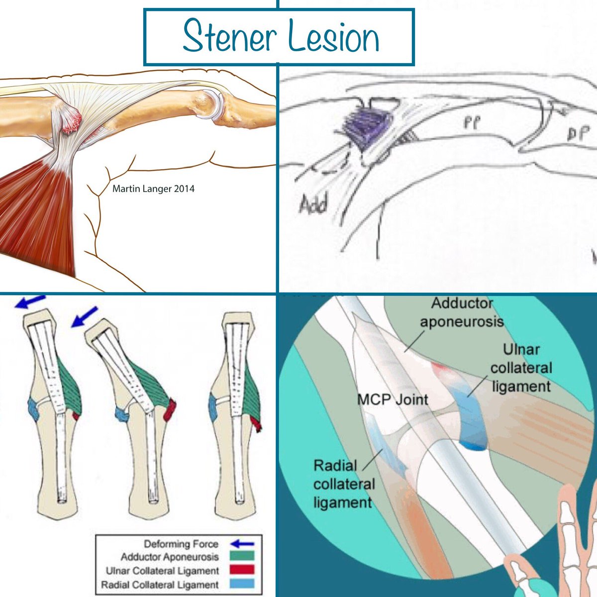 Stener Lesion