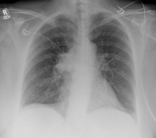 Hilum In Lung Cancer Cxr
