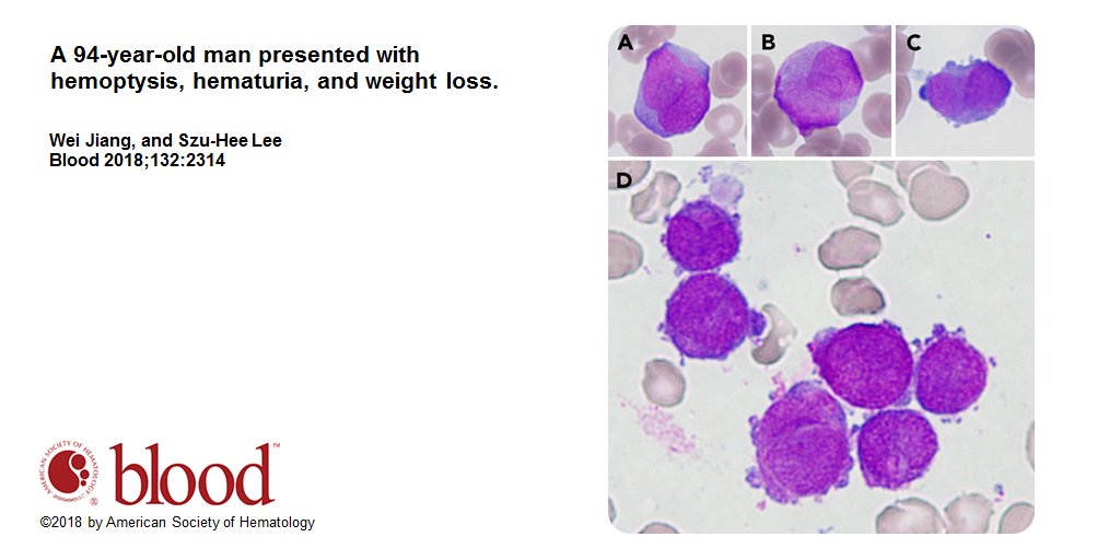 Acute Promyelocytic Leukemia Microgranular Variant