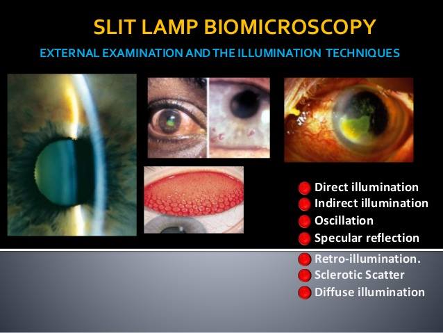 Specular Reflection Slit Lamp Technique