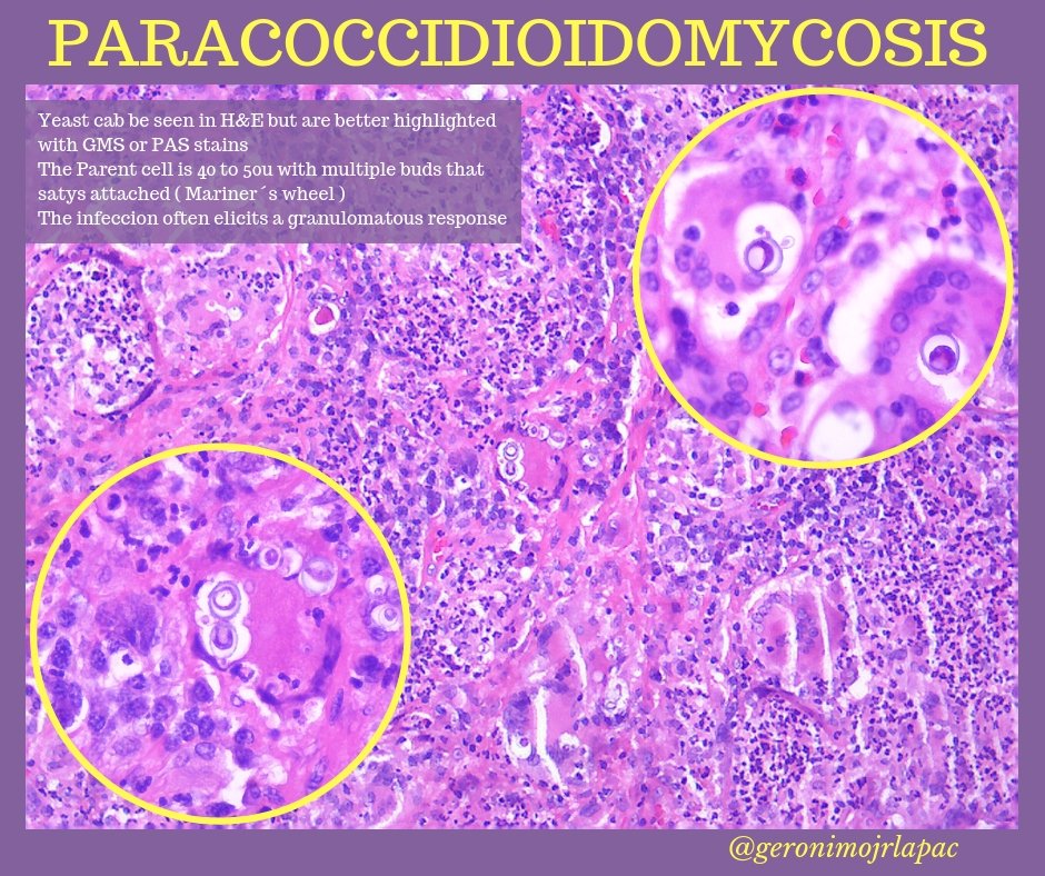 Paracoccidioidomycosis Histology
