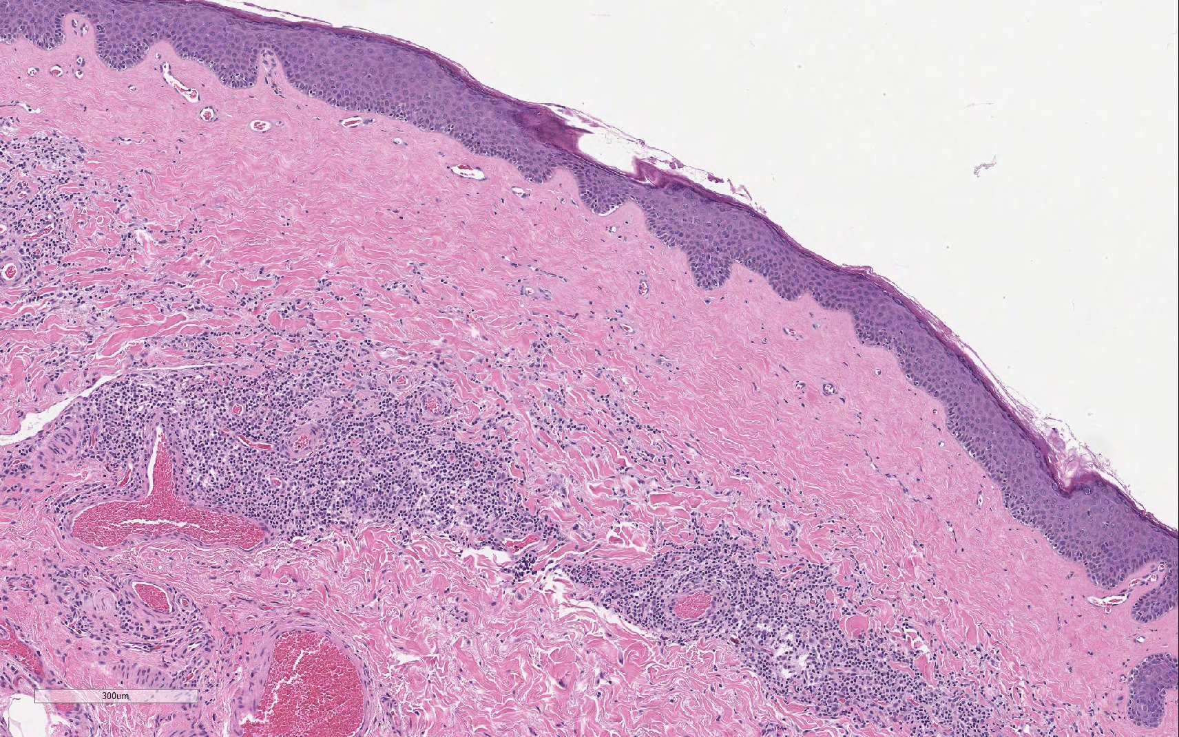 Balanitis Xerotica Obliterans Histology