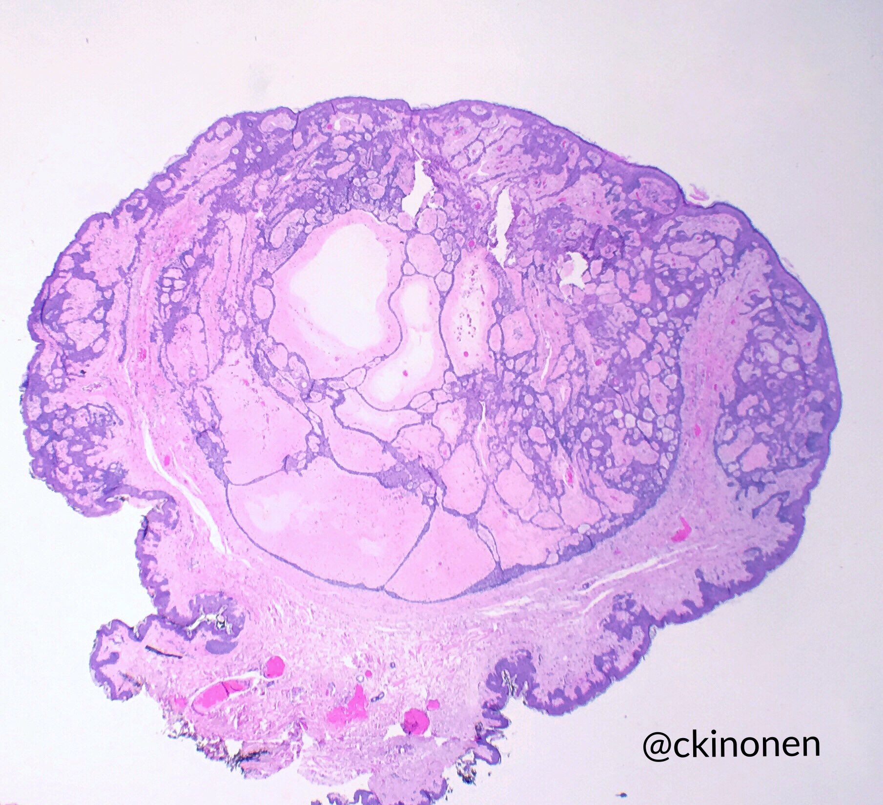 Fibroepithelioma Of Pinkus