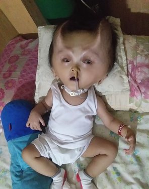 Hydranencephaly Infant