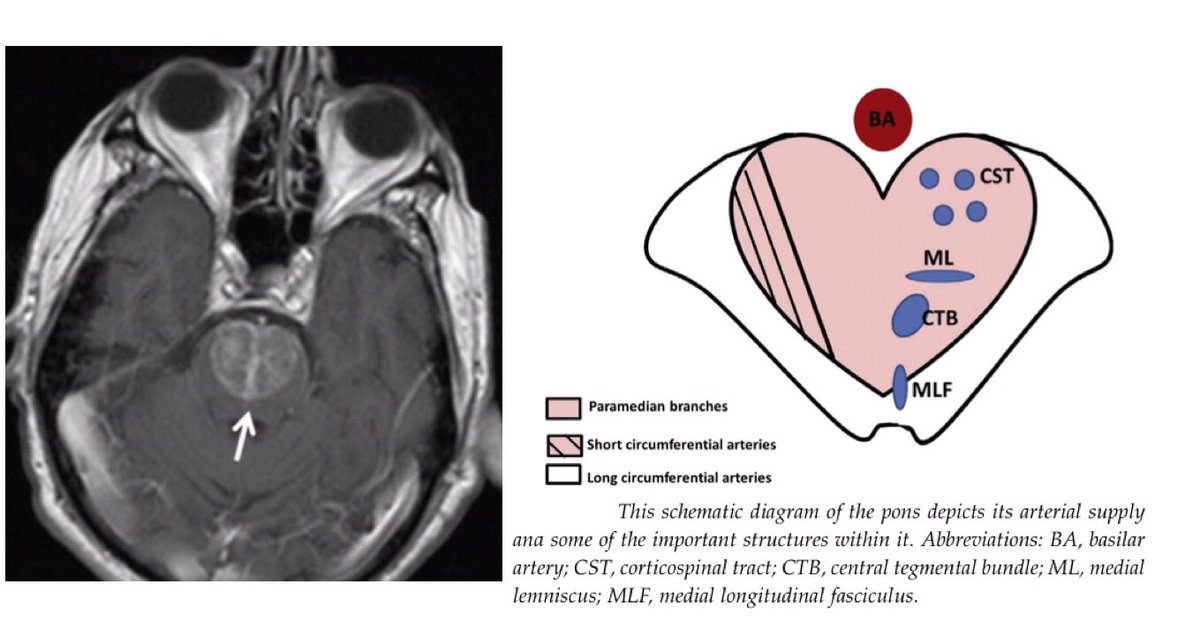 Paramedian Pontine Infarct