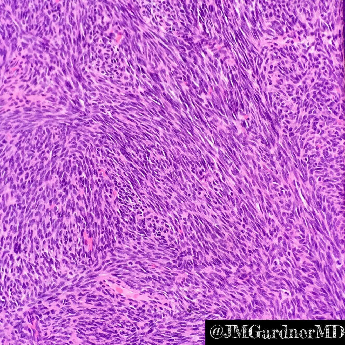 Fibrosarcoma Histology