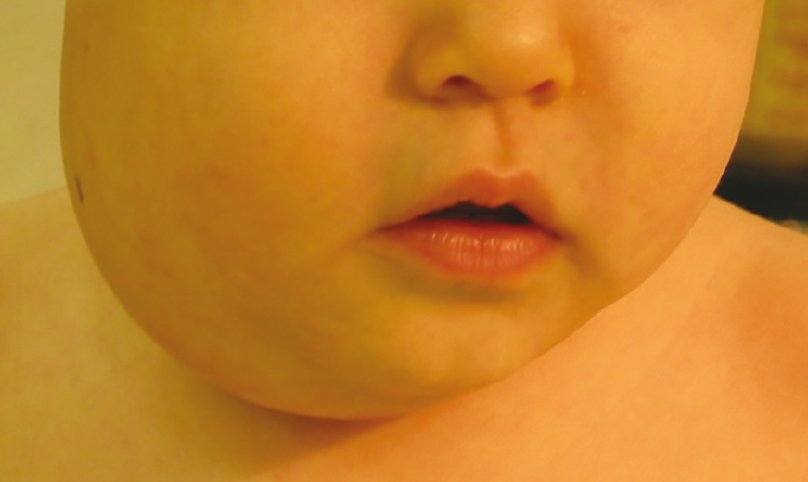 Parotid Gland Swelling In Children