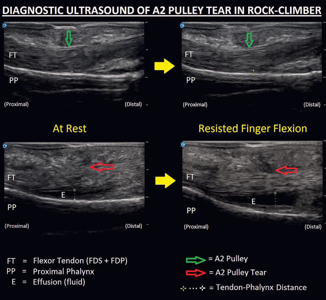 A2 Pulley Tear Up To Date