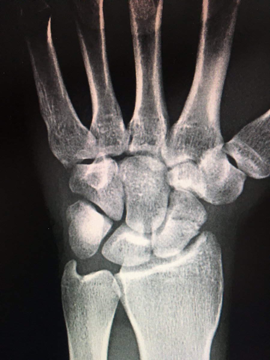 Hueso Escafoides Radiografia Big Offers | brunofuga.adv.br