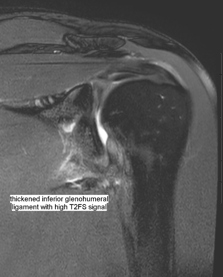 Coracohumeral Ligament Mri
