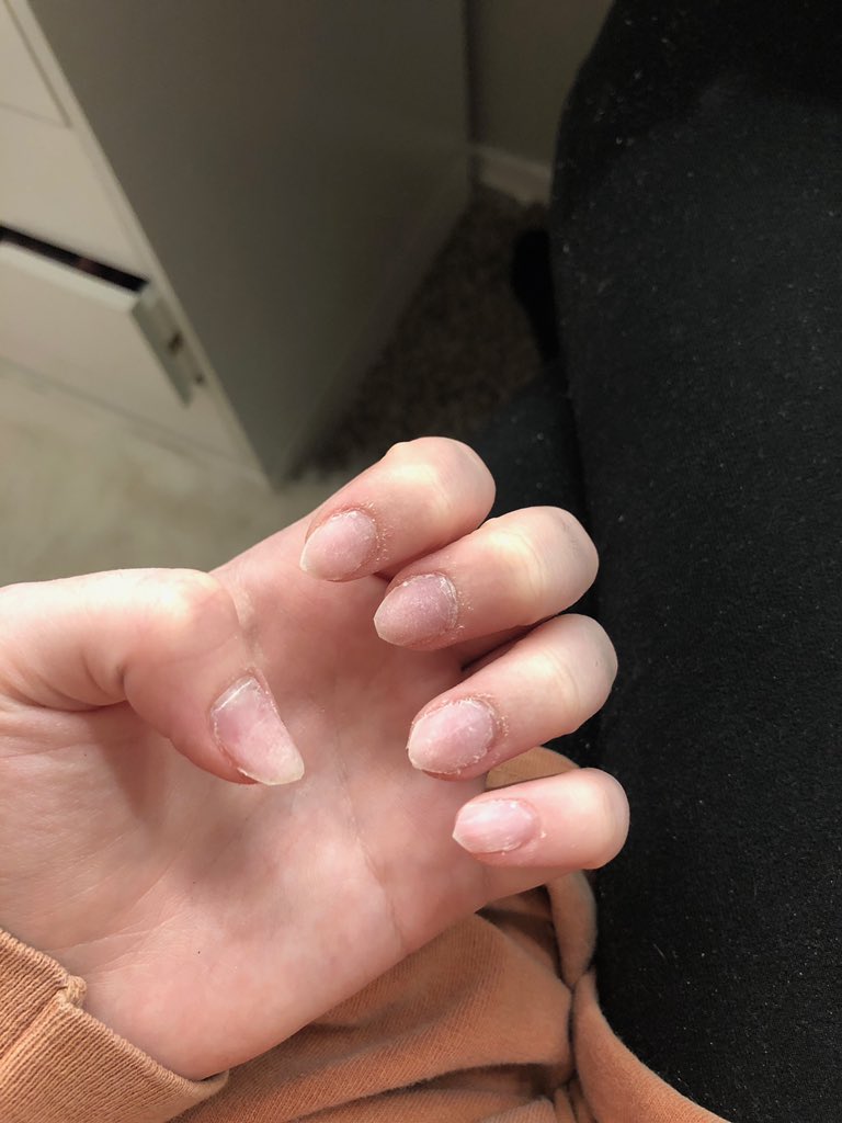 Extended Hyponychium