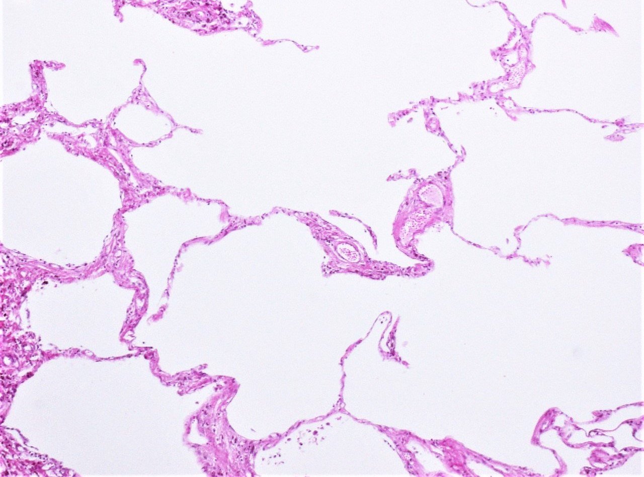 Emphysema Lung Slide