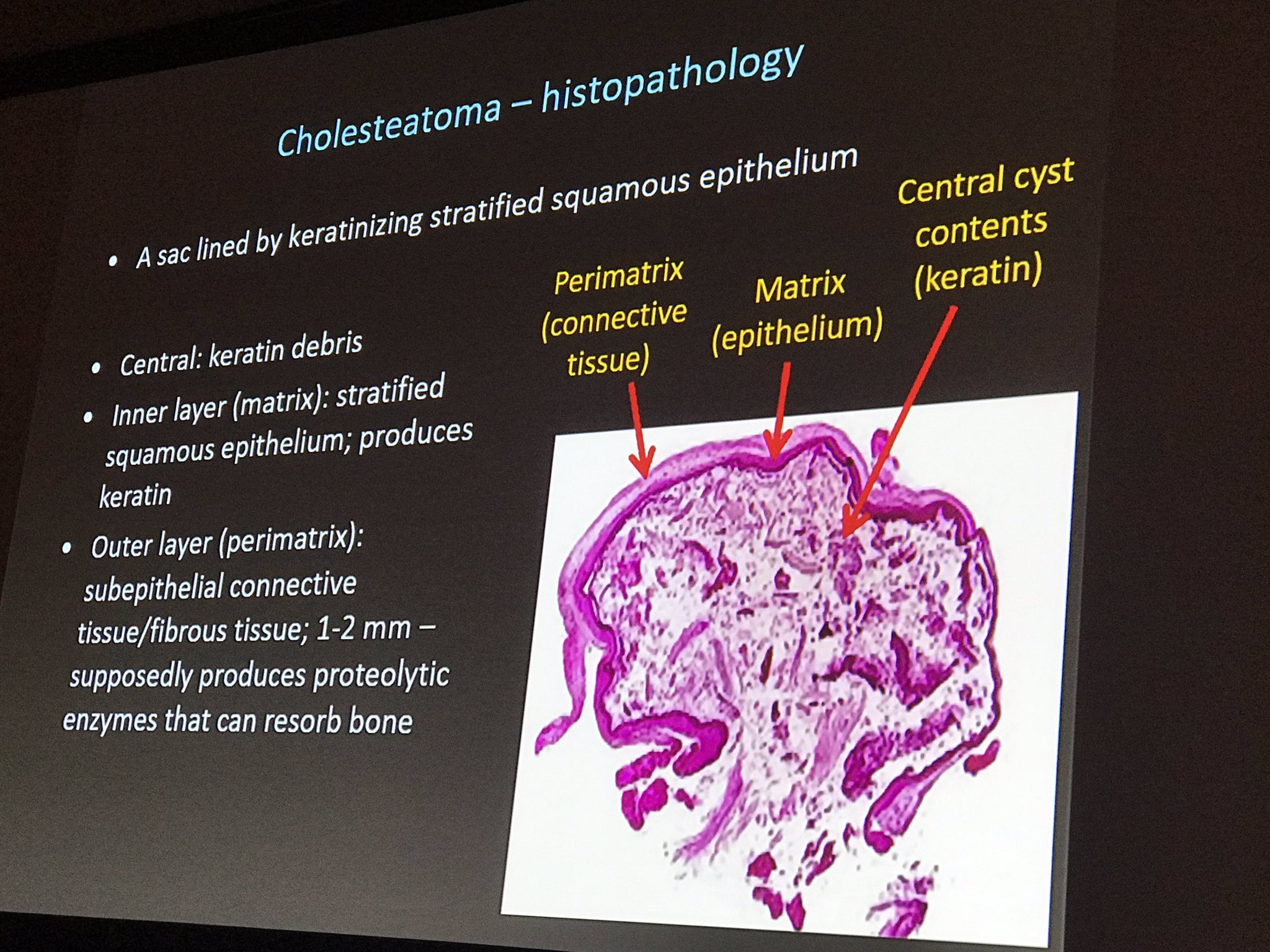 Cholesteatoma Histology
