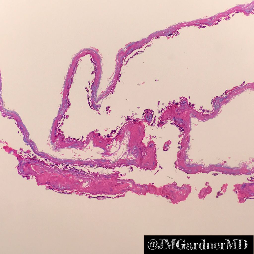 Staph Scalded Skin Syndrome Histology
