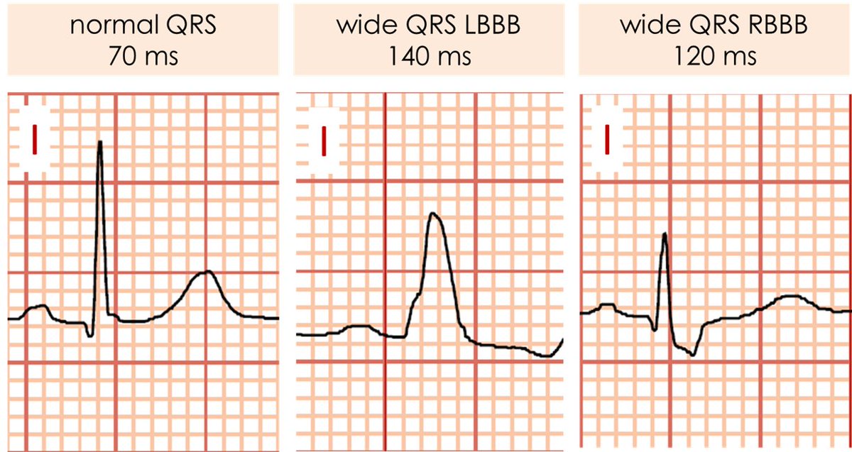 Wide Qrs Complex