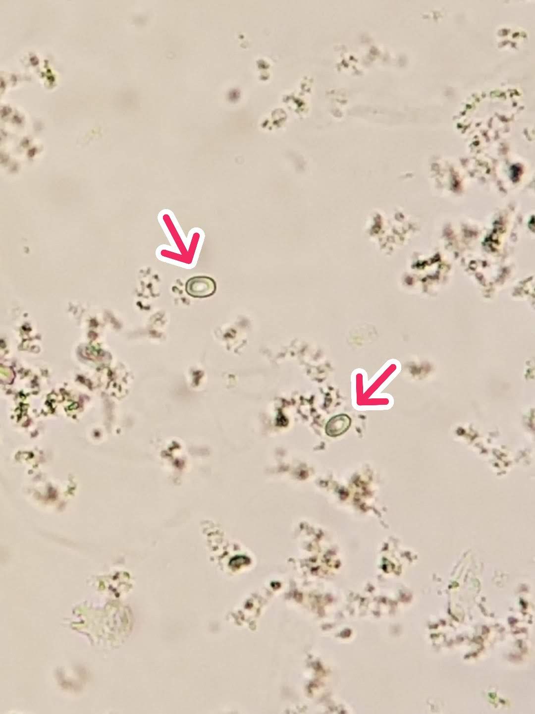 Calcium Oxalate Crystals In Urine