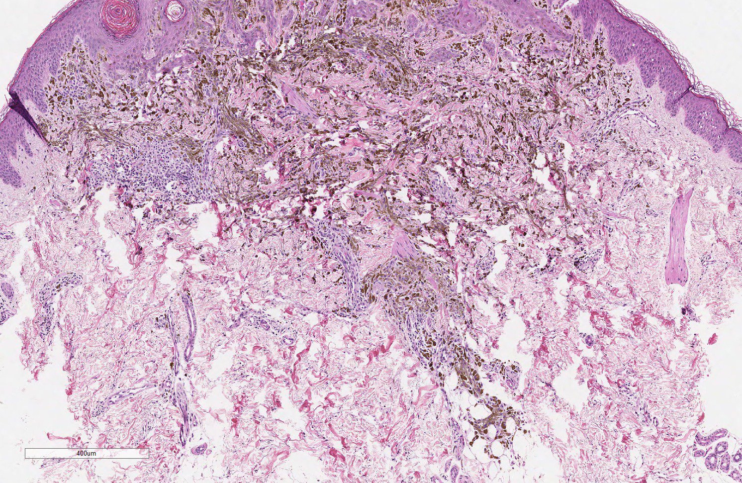 Blue Nevus Histology