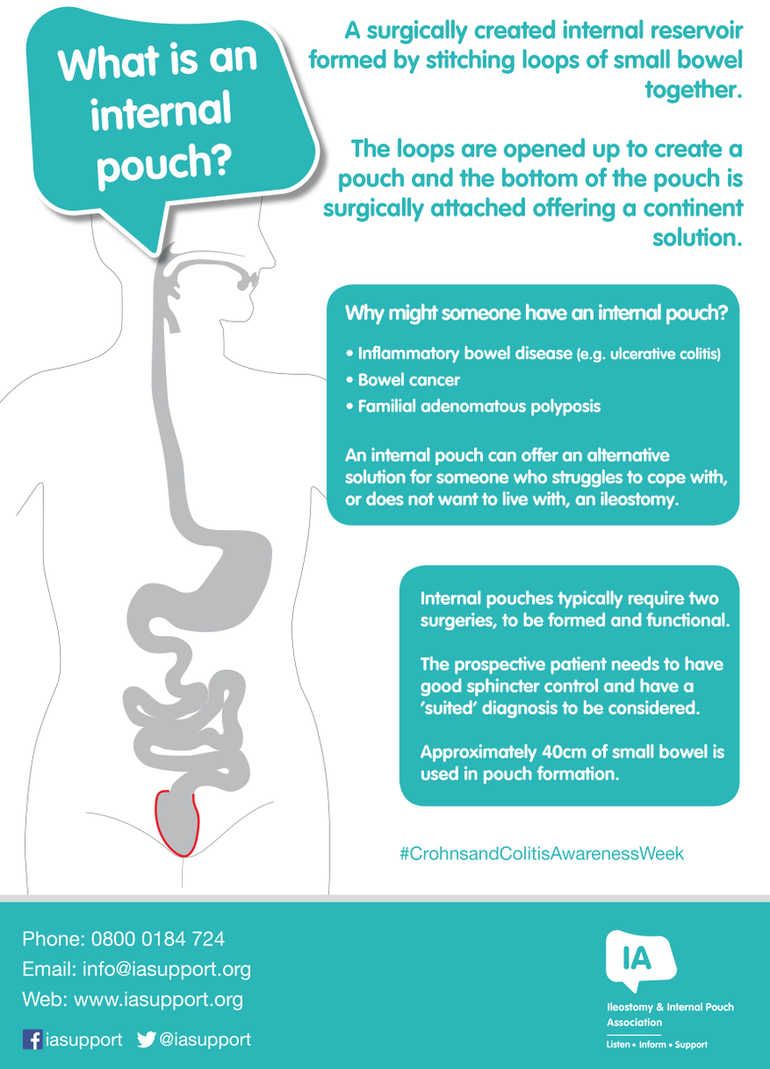 Ileostomy J Pouch