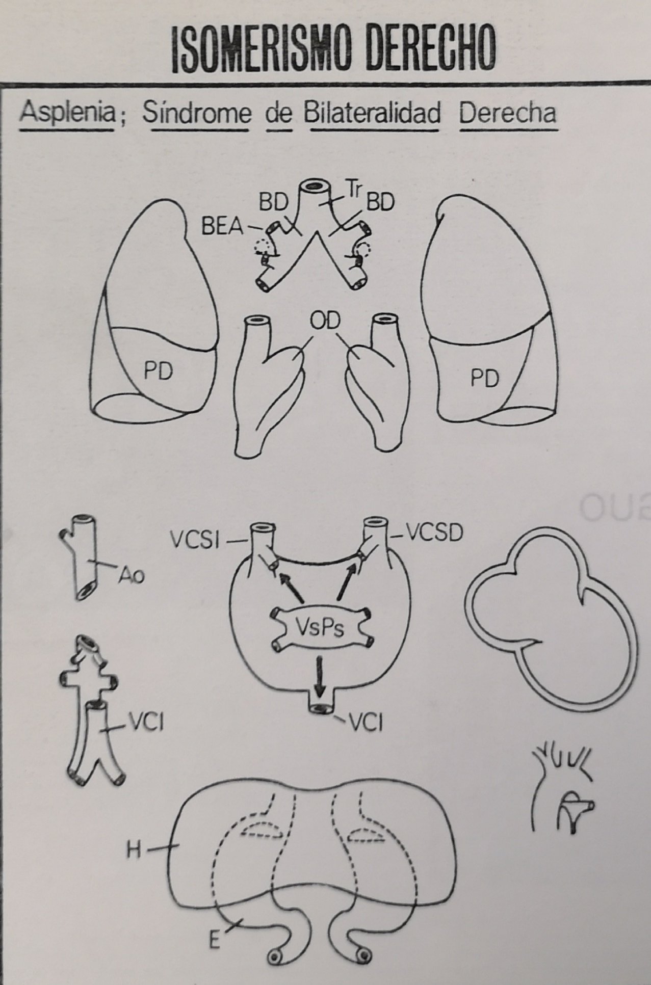 Isomerismo Cardiaco