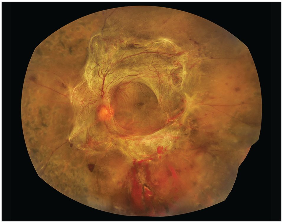 Tractional Retinal Detachment