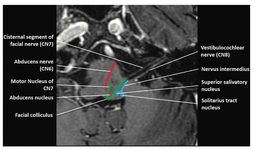 5th Of Facial Nerve Mri