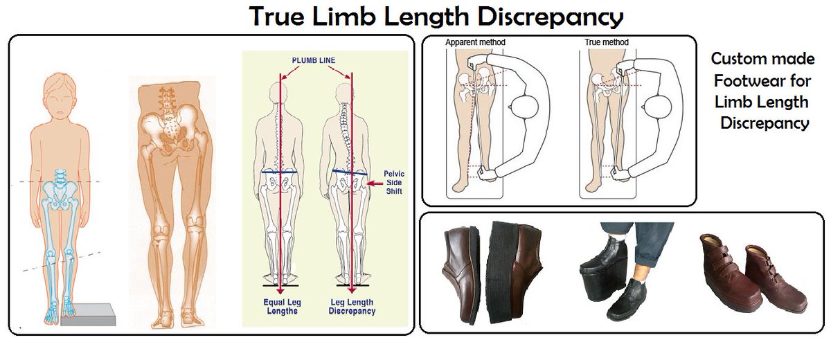 True Leg Length Discrepancy Test