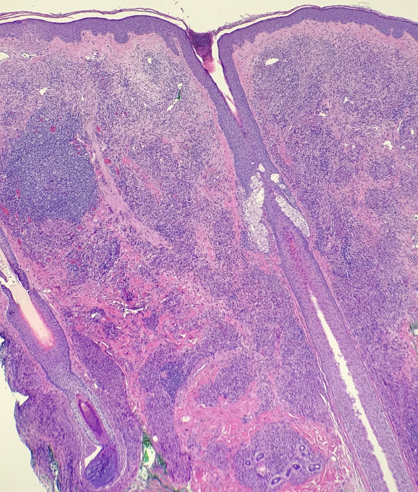Granuloma Faciale Histology