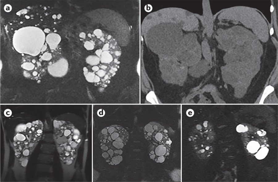 Polycystic Kidney Disease Mri