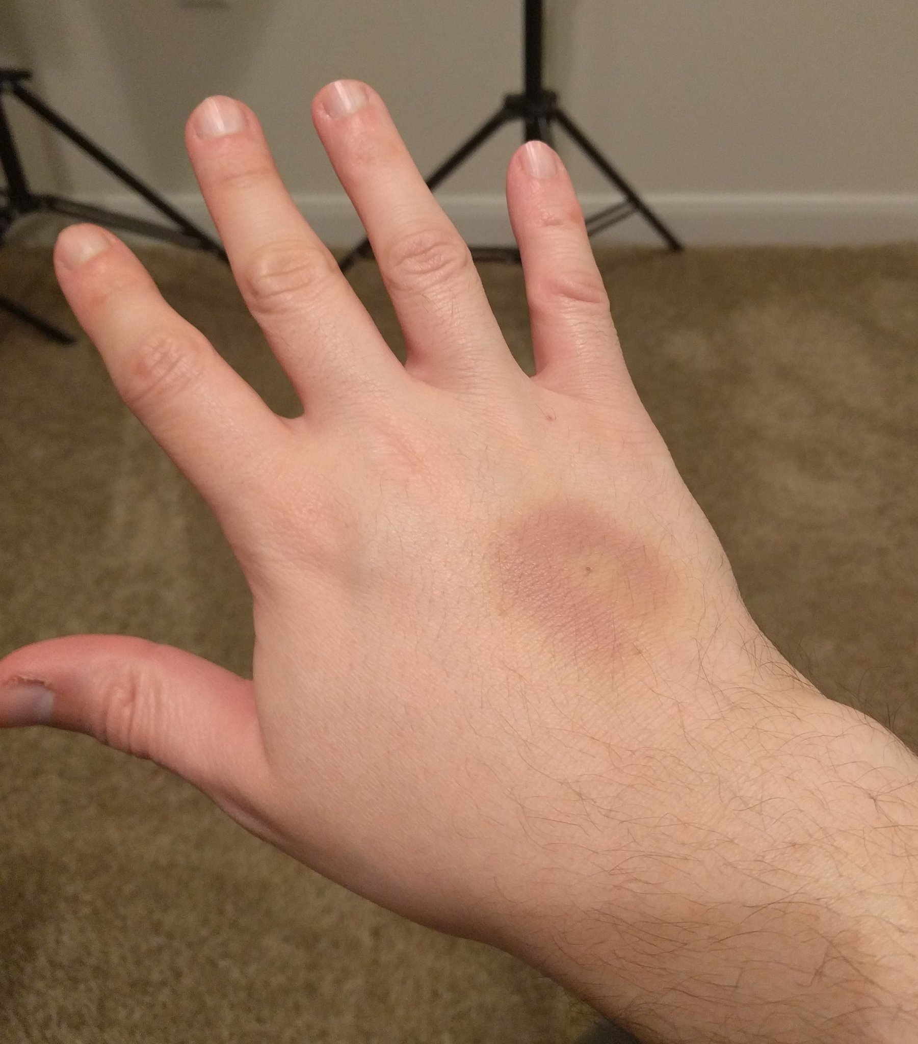 Iv Hematoma