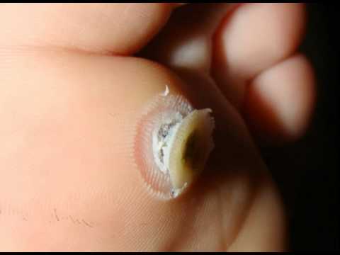 Plantar Wart Root