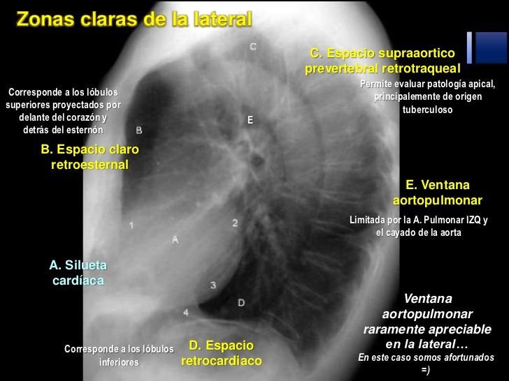 Anatomía De La Radiografía De Tórax Lateral