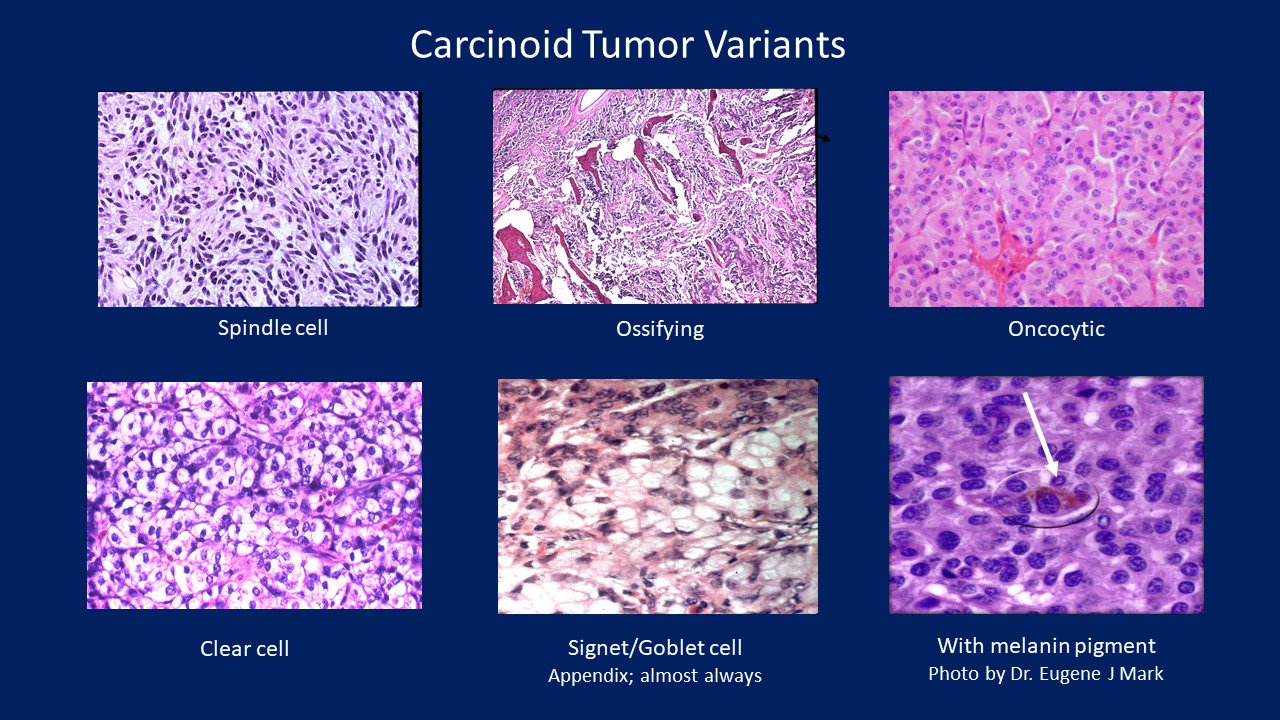 Carcinoid Syndrome Histology