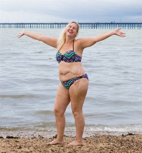 British Skin Foundation on Twitter: "Sylvia Mac aka @LoveDisfigure blogs about her scars https ...