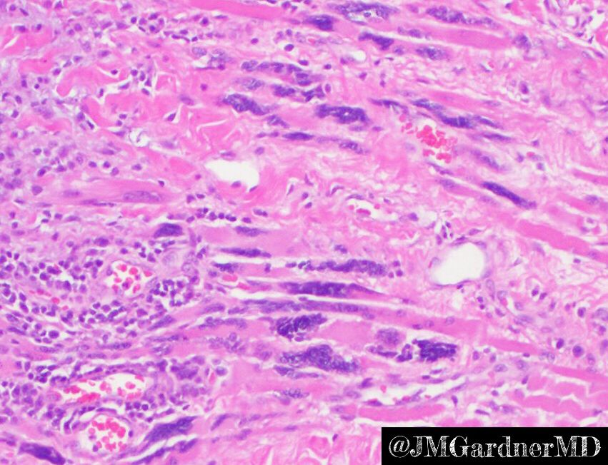 Muscle Atrophy Histology