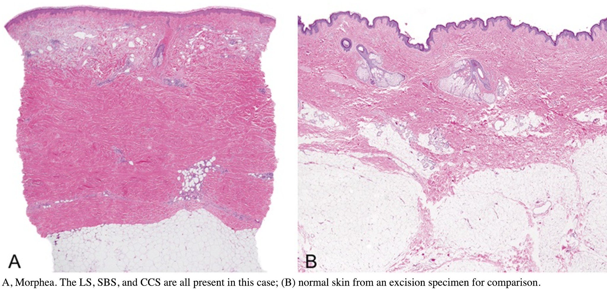 Morphea Histopathology