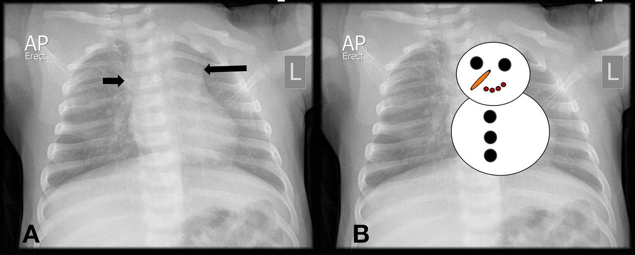 Pulmonary Veins Xray
