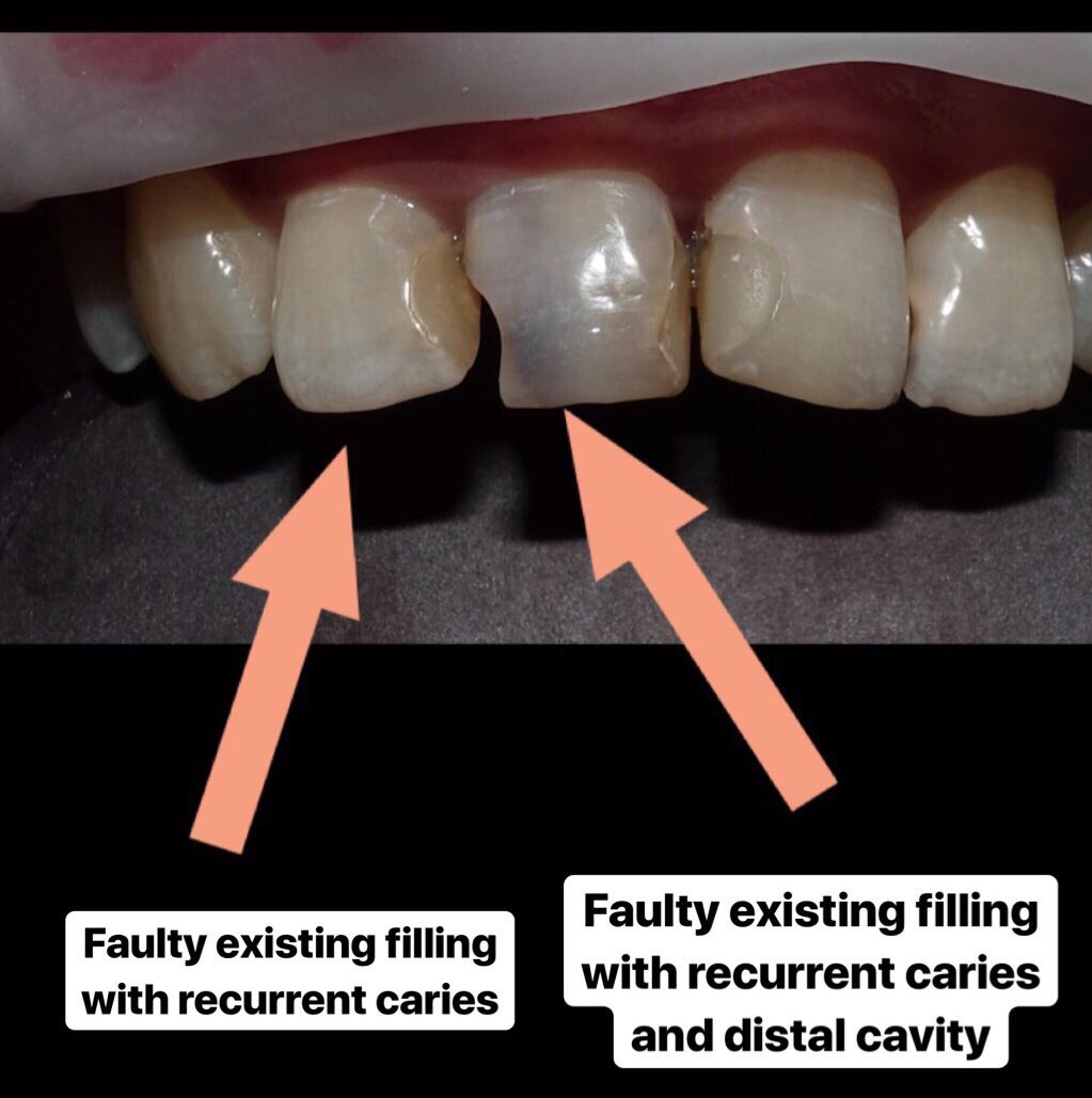 Recurrent Caries