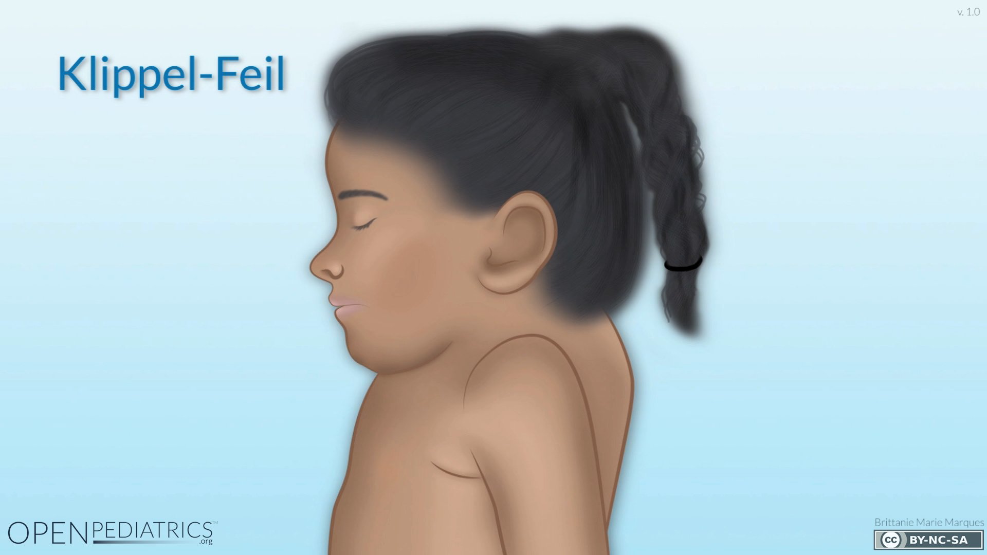 Klippel Feil Syndrome