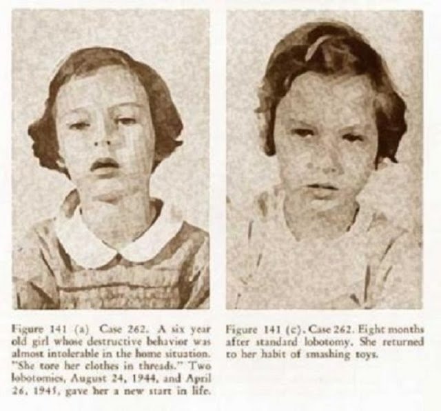 Lobotomy Before And After