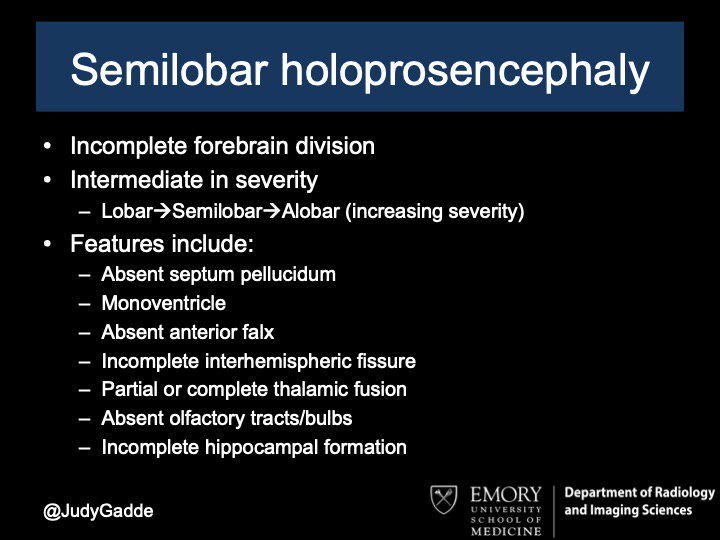 Holoprosencephaly Radiology