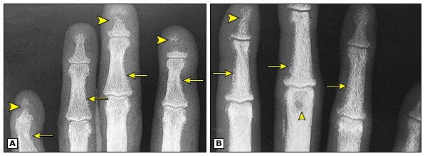 Osteitis Fibrosa Cystica X Ray