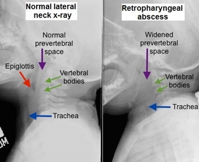 Retropharyngeal Abscess Lateral Neck X Ray