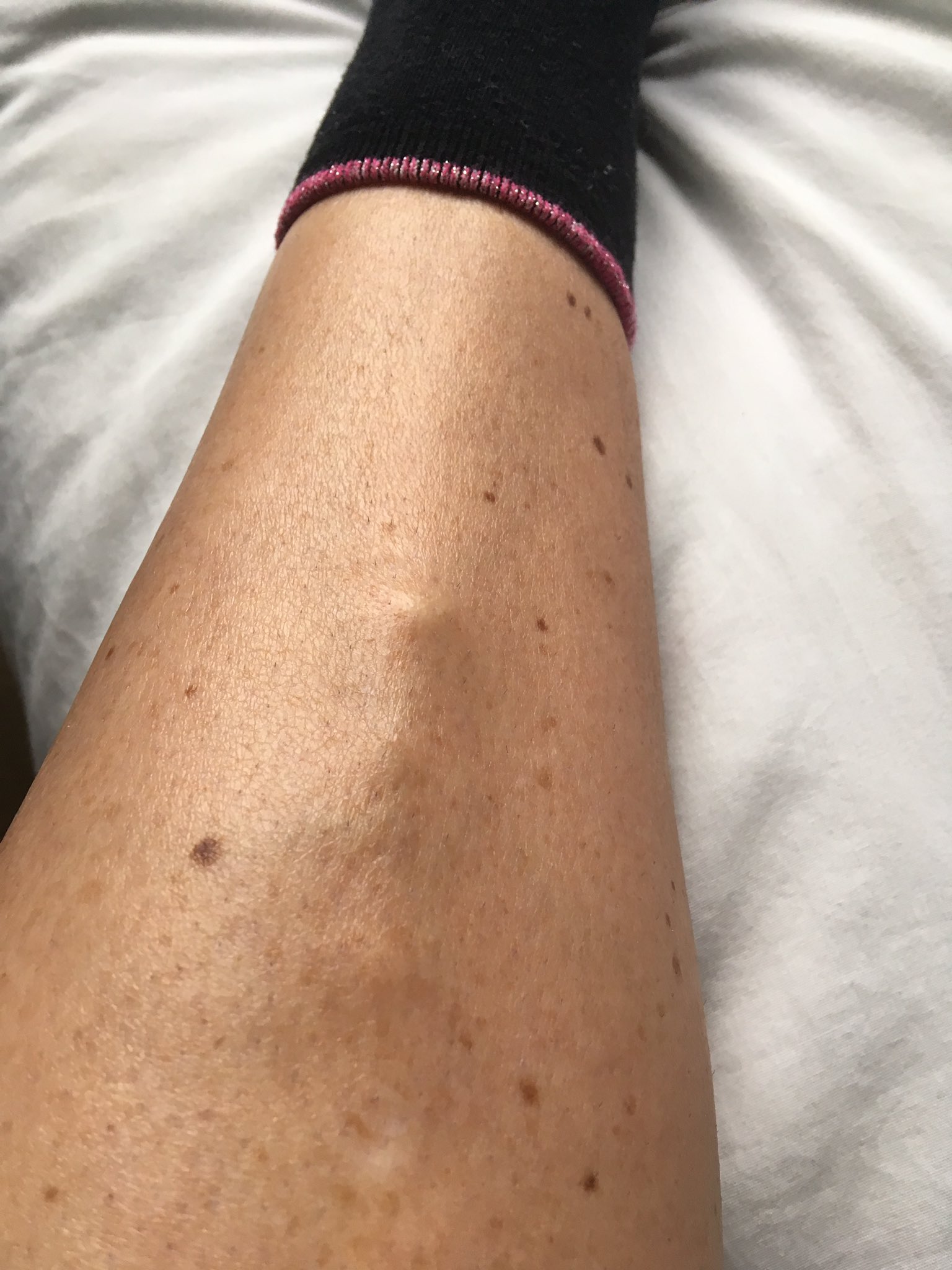 Posterior Shin Splints Bumps