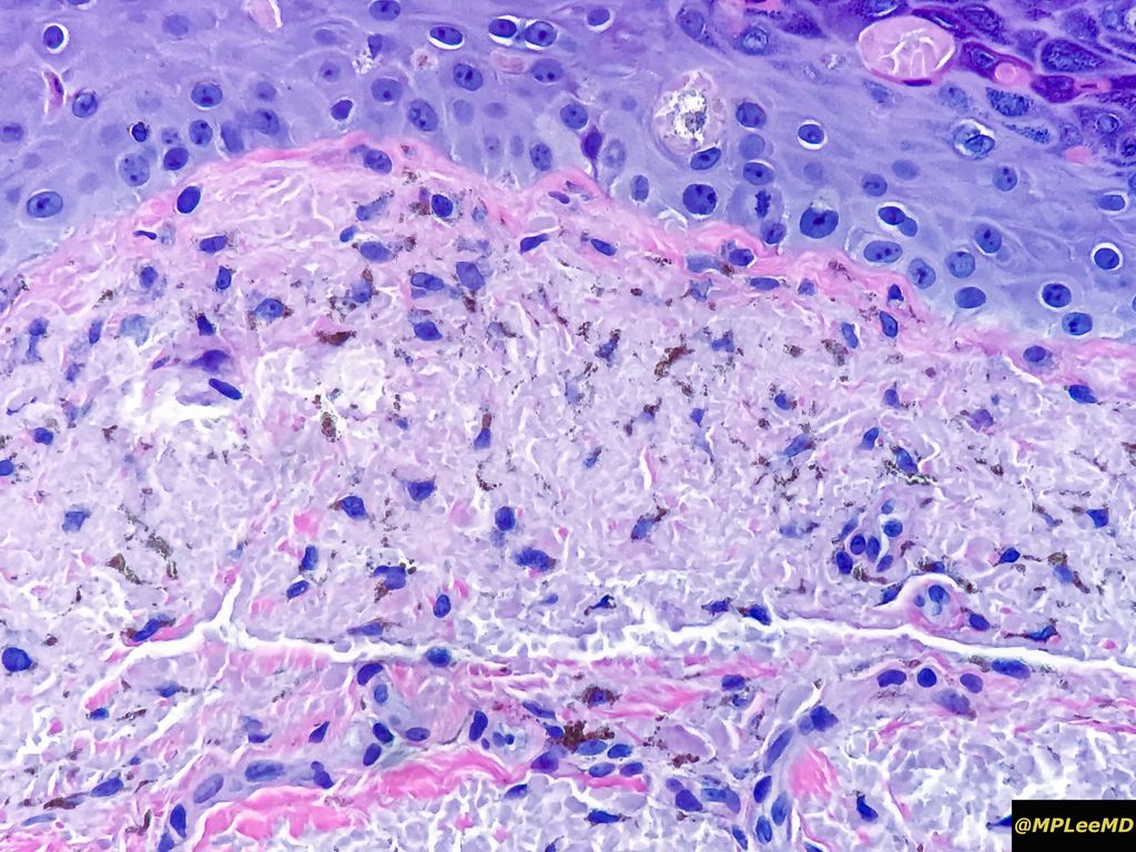 Excoriation Histology